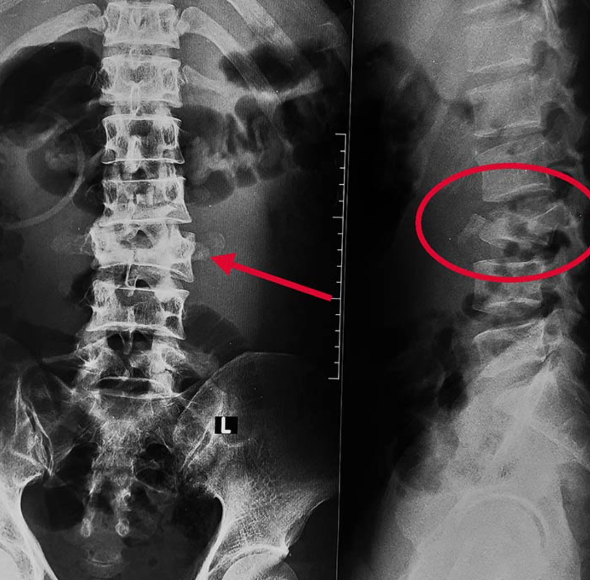 Chụp X quang cột sống thắt lưng có thể cho biết điều gì?